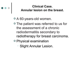 annular lesion on the breast | PPT