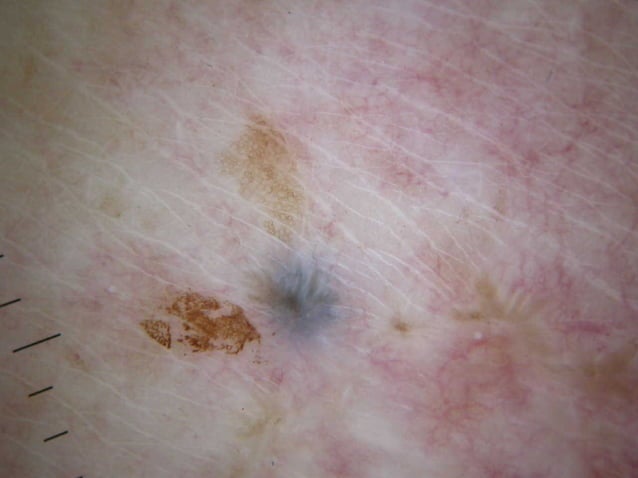 annular lesion on the breast | PPT