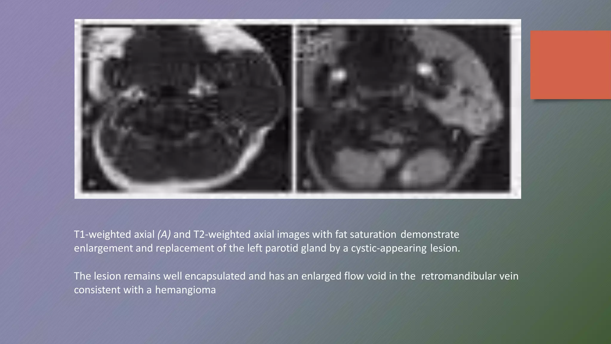 Radiodiagnosis of salivary gland tumours | PPTX