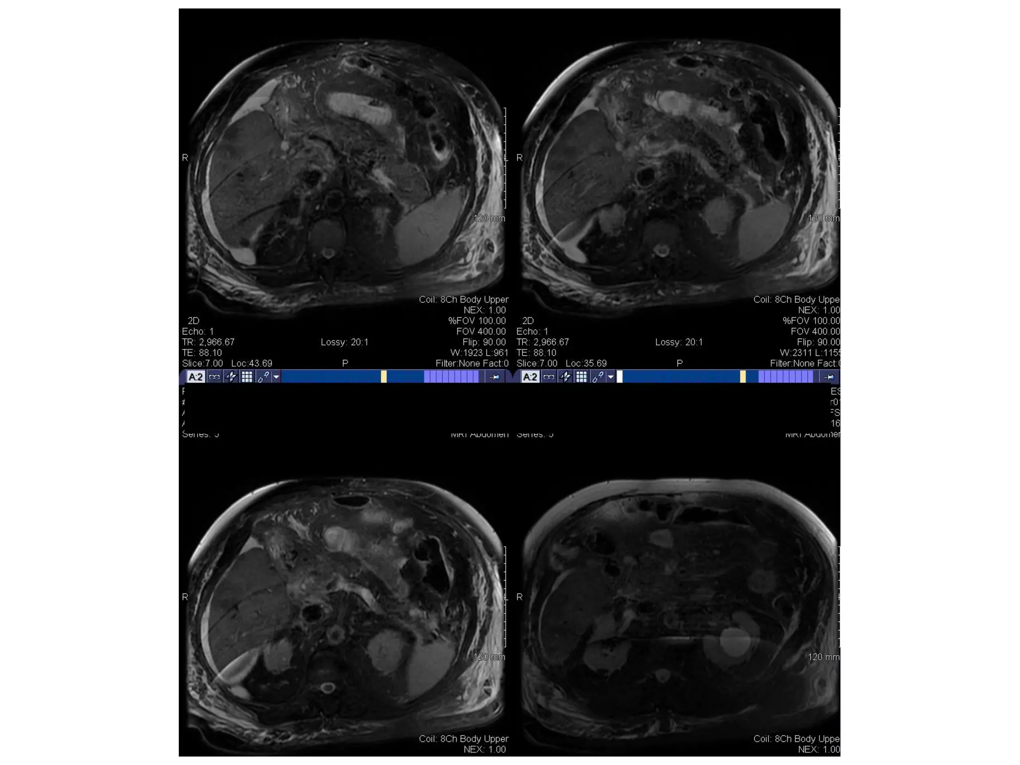 Radioembolization induced liver disease, a brief and limited ...