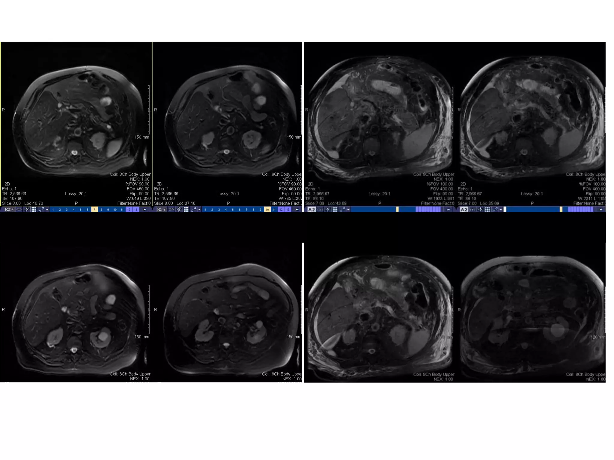 Radioembolization induced liver disease, a brief and limited ...