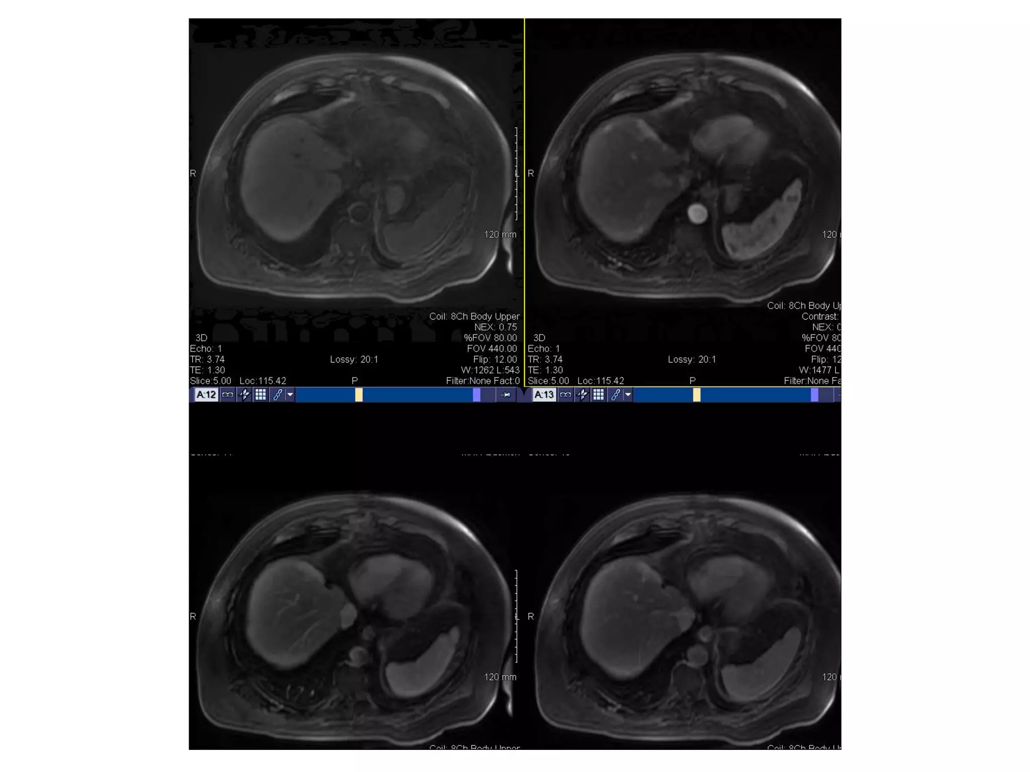 Radioembolization induced liver disease, a brief and limited ...