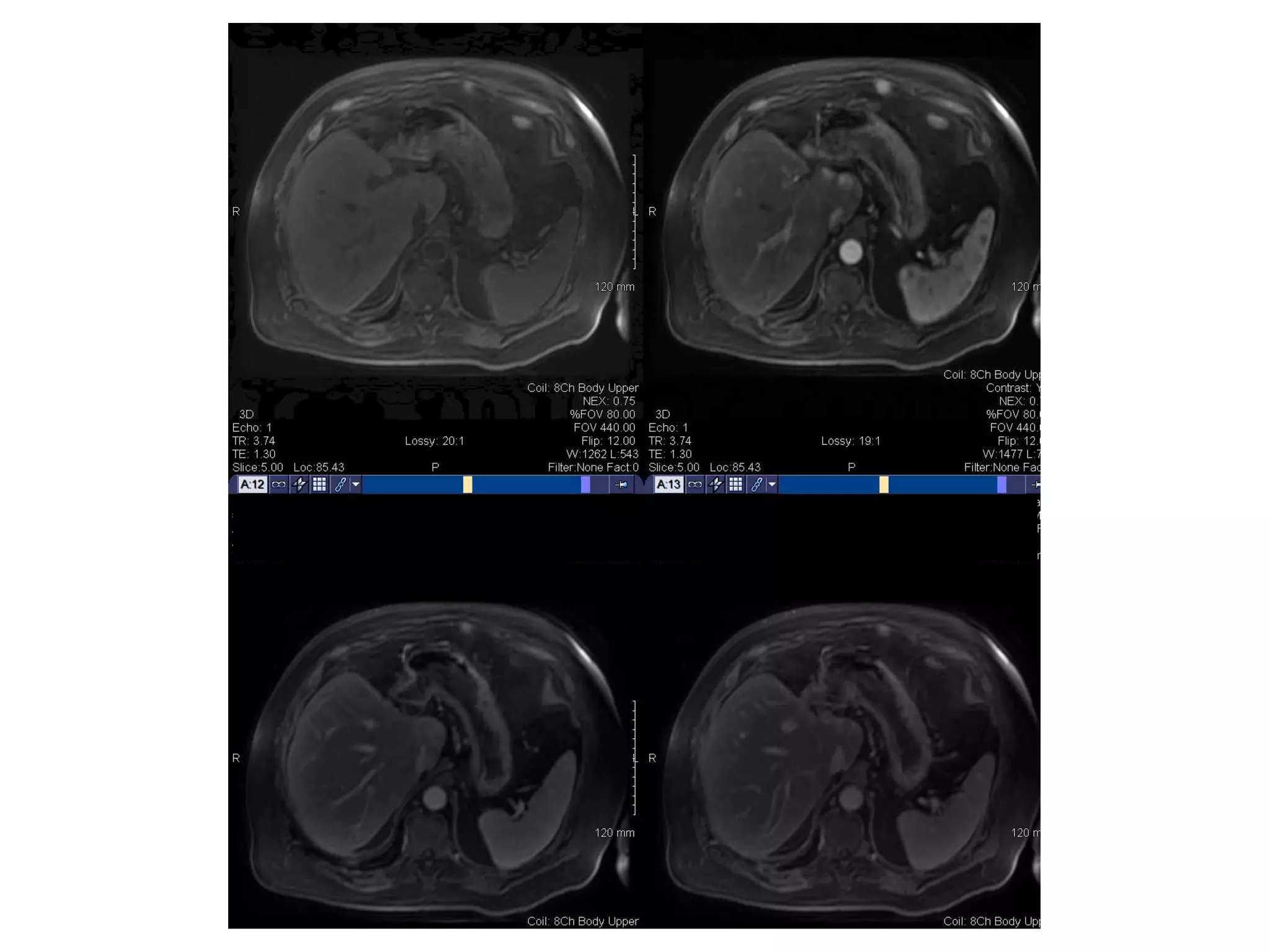 Radioembolization induced liver disease, a brief and limited ...