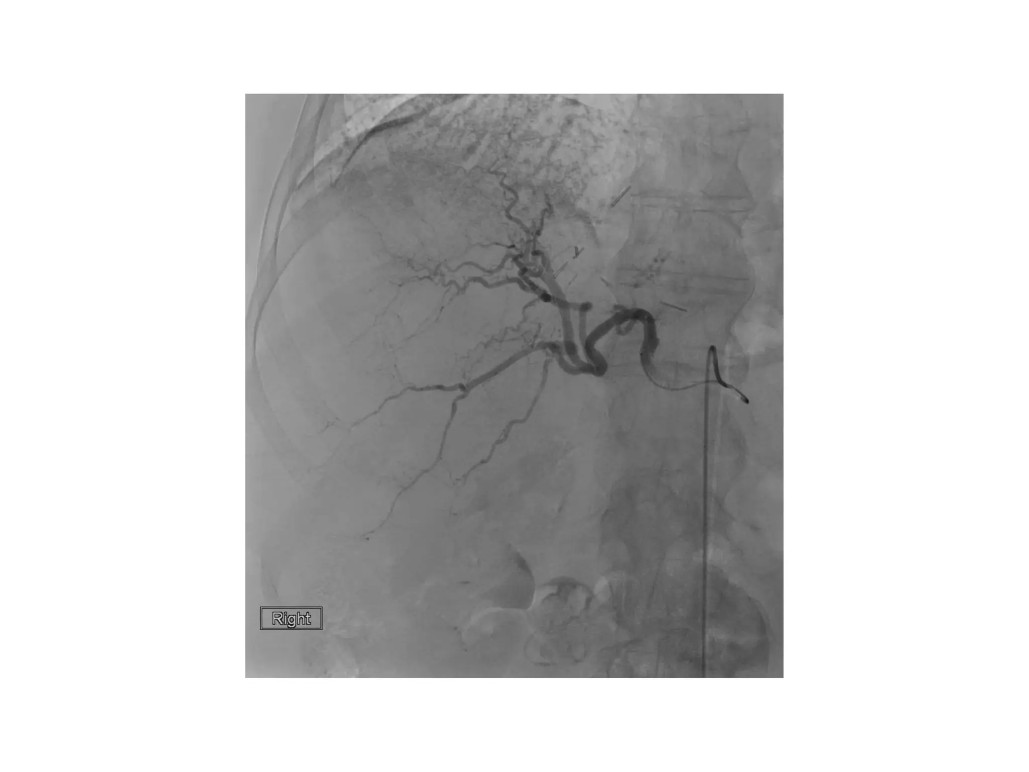 Radioembolization induced liver disease, a brief and limited ...