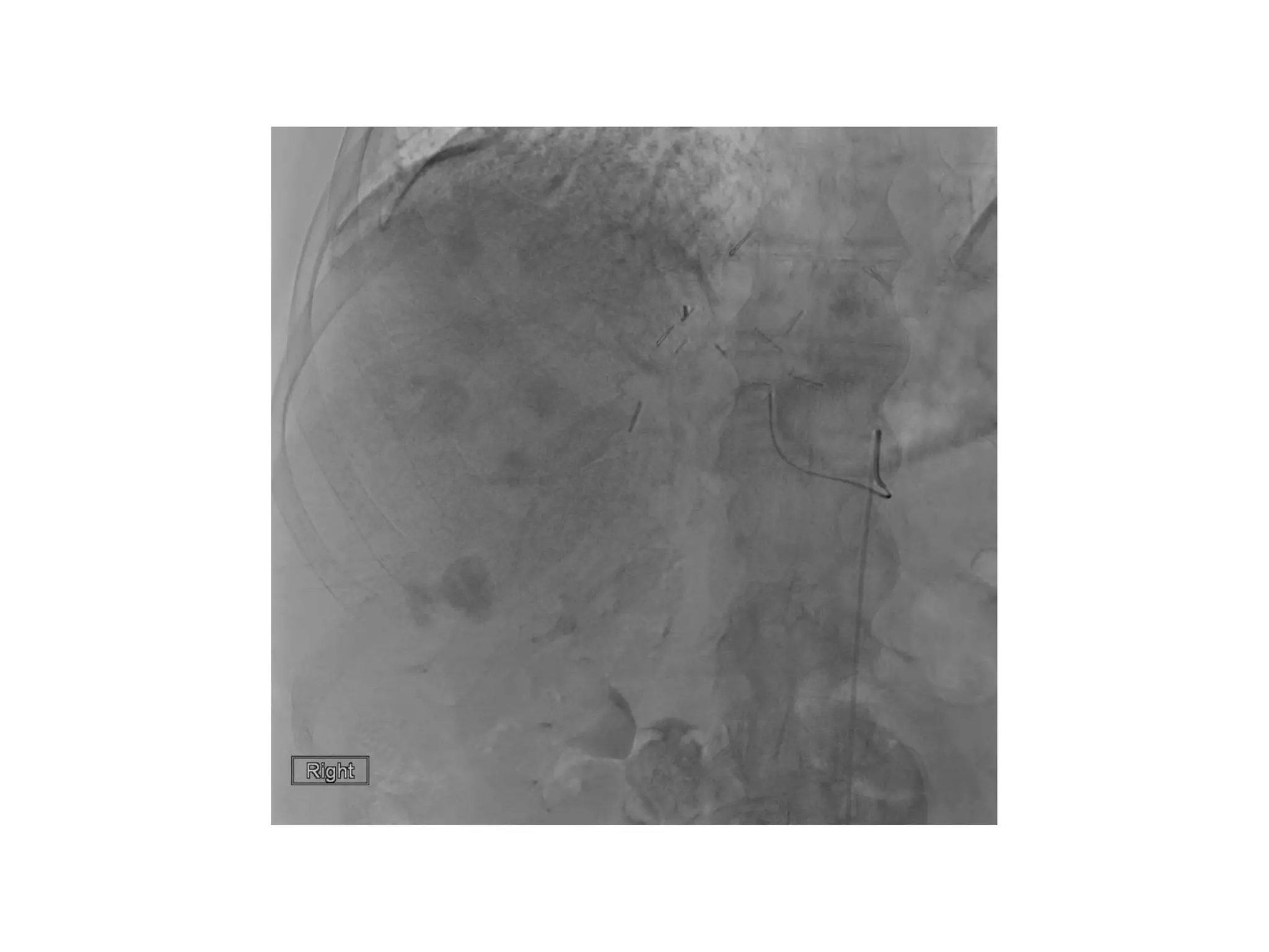 Radioembolization induced liver disease, a brief and limited ...