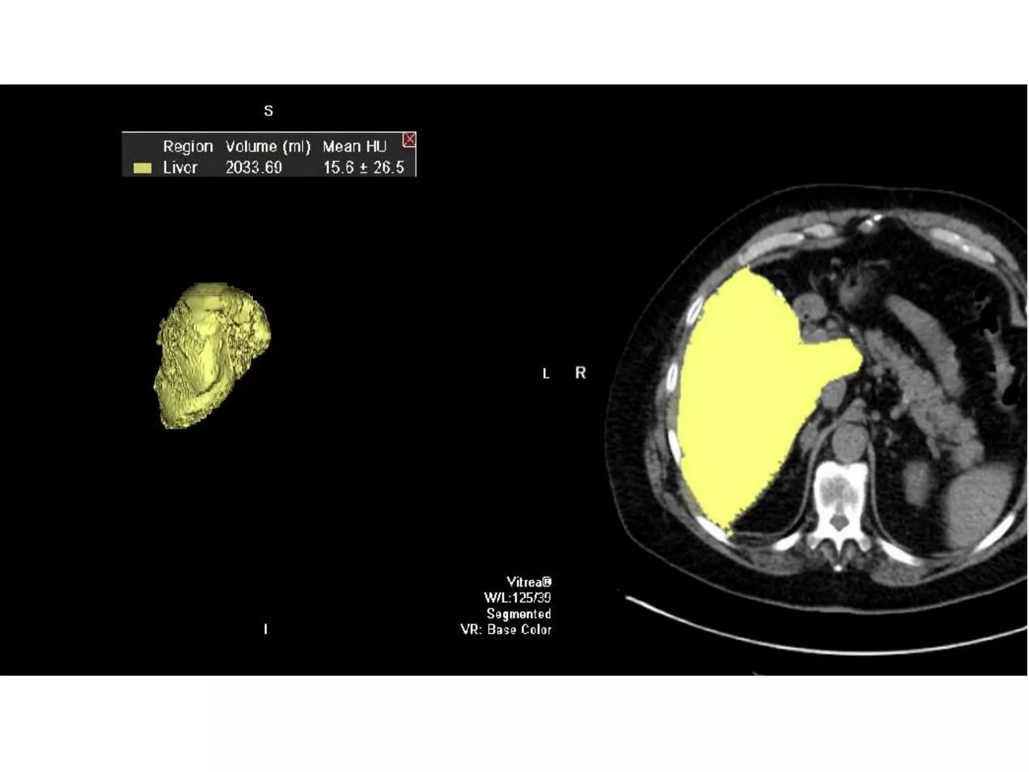 Radioembolization induced liver disease, a brief and limited ...