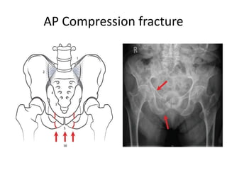 Radiological evaluation of Lower Limb in acute ED setting !! | PPTX