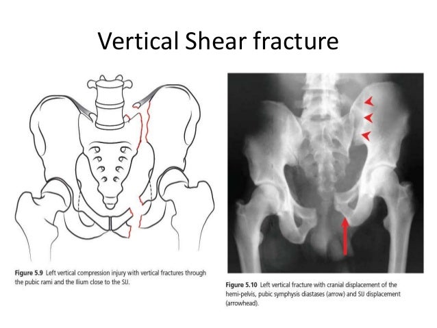 Radiological evaluation of Lower Limb in acute ED setting