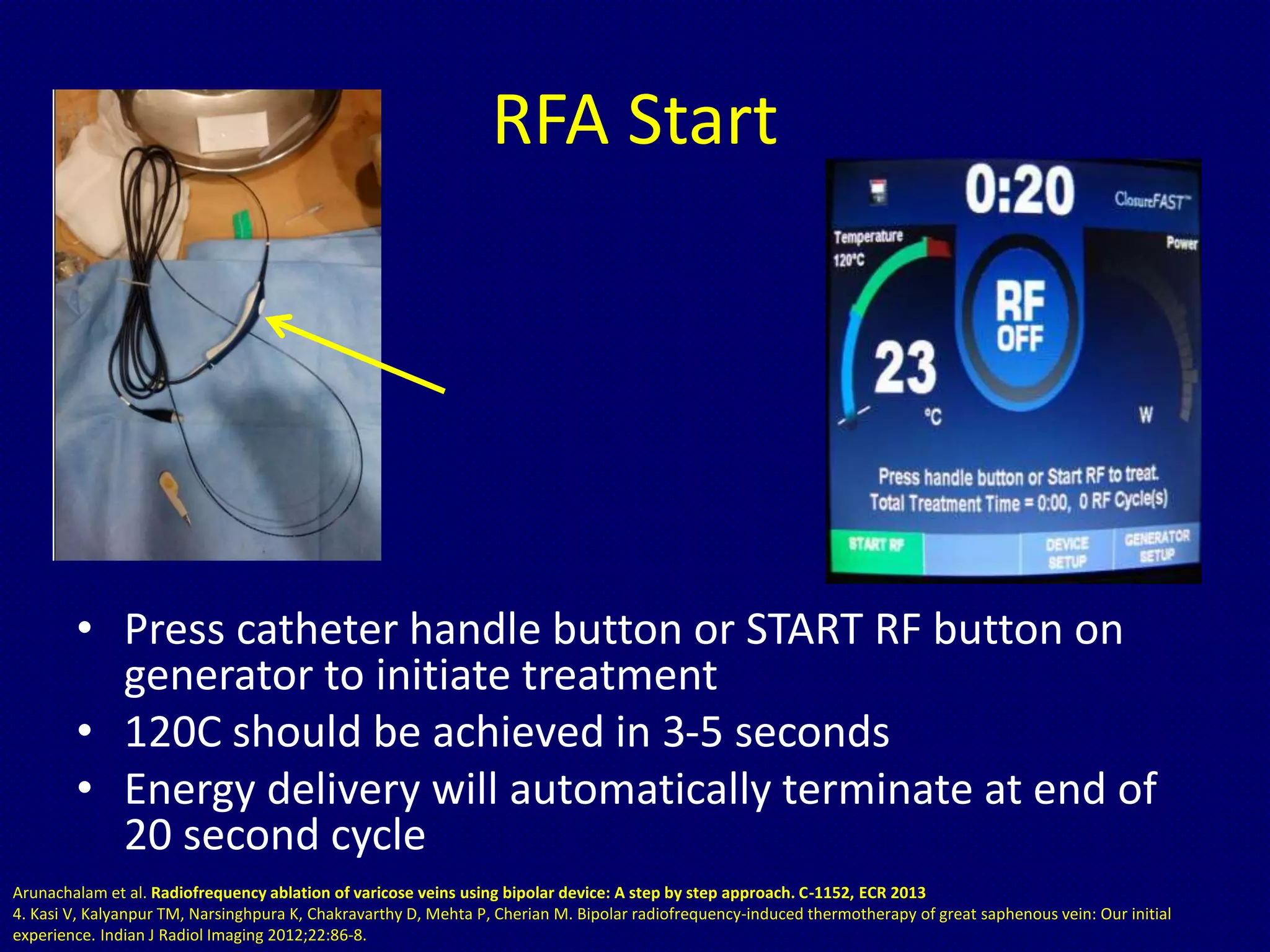 Radiofrequency ablation of varicose veins Dr. Muhammad Bin Zulfiqar | PPTX