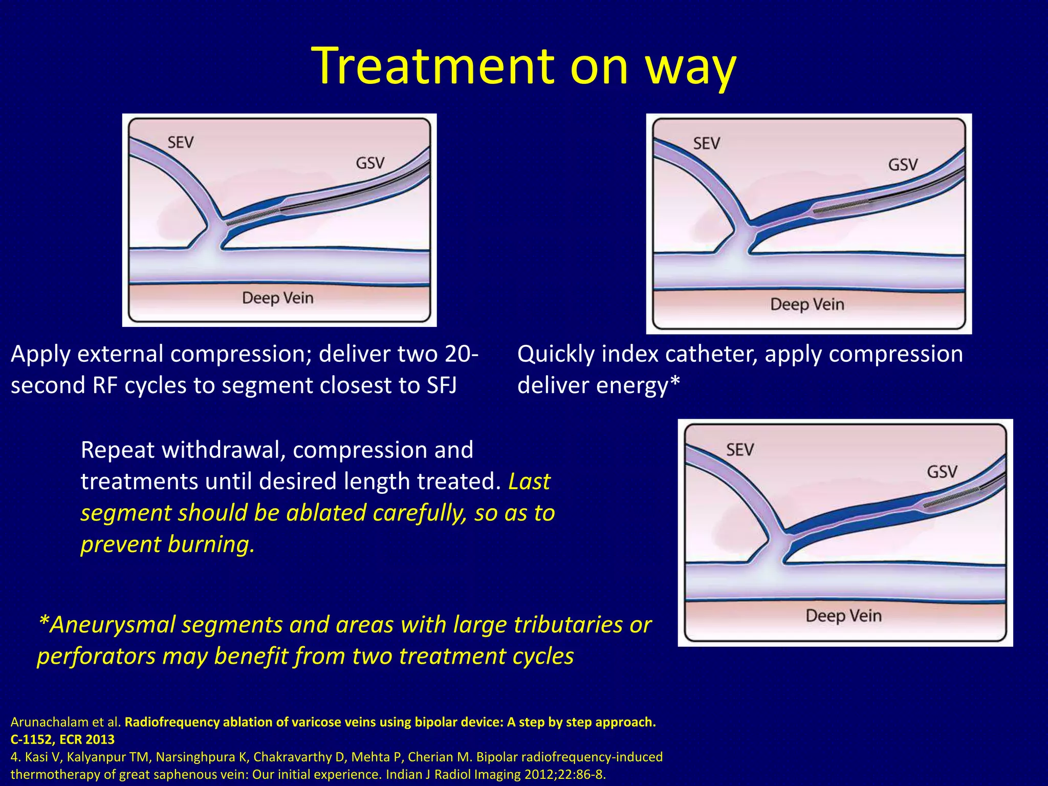 Radiofrequency ablation of varicose veins Dr. Muhammad Bin Zulfiqar | PPTX