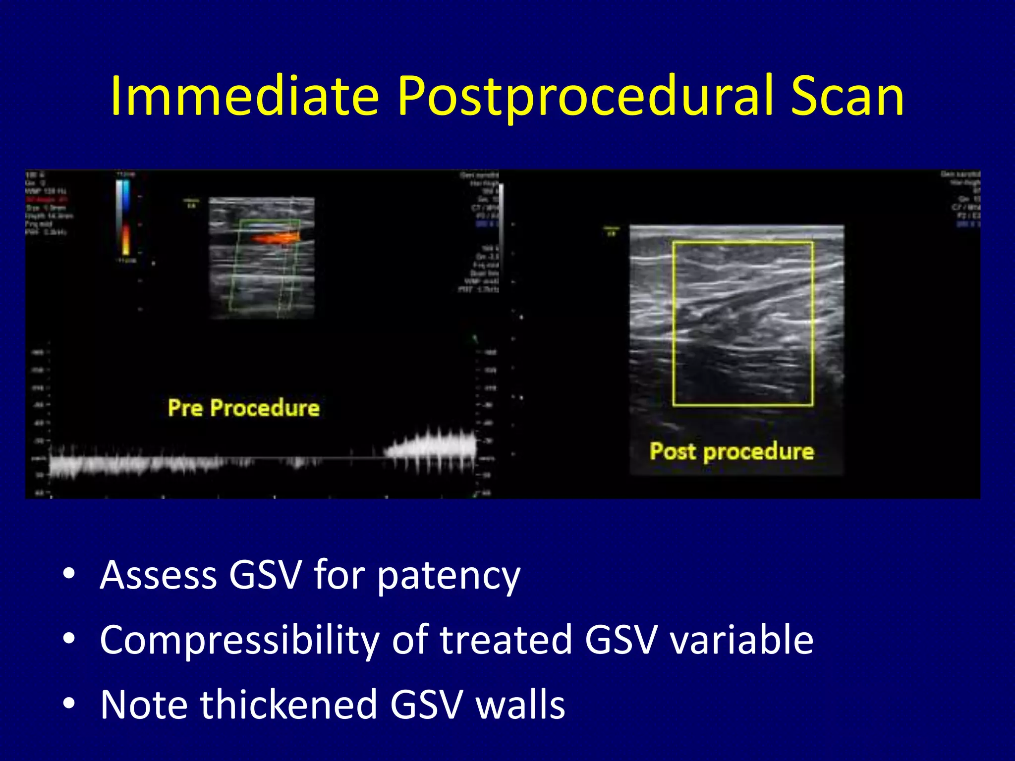 Radiofrequency ablation of varicose veins Dr. Muhammad Bin Zulfiqar | PPTX