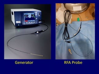 Radiofrequency ablation of varicose veins Dr. Muhammad Bin Zulfiqar | PPTX
