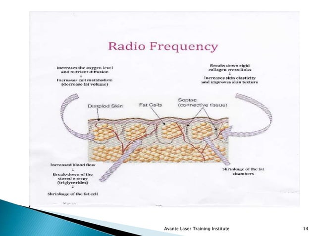 Radio frequency body contouring | PPTX
