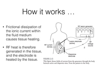 Radiofrequency in chronic pain management | PDF