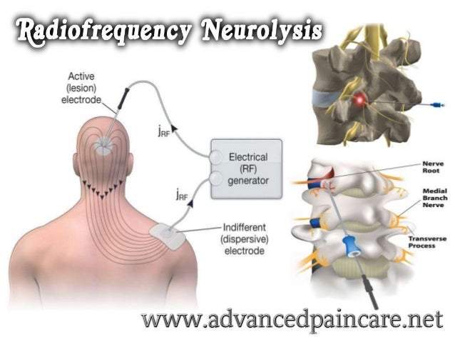 Radiofrequency Neurolysis