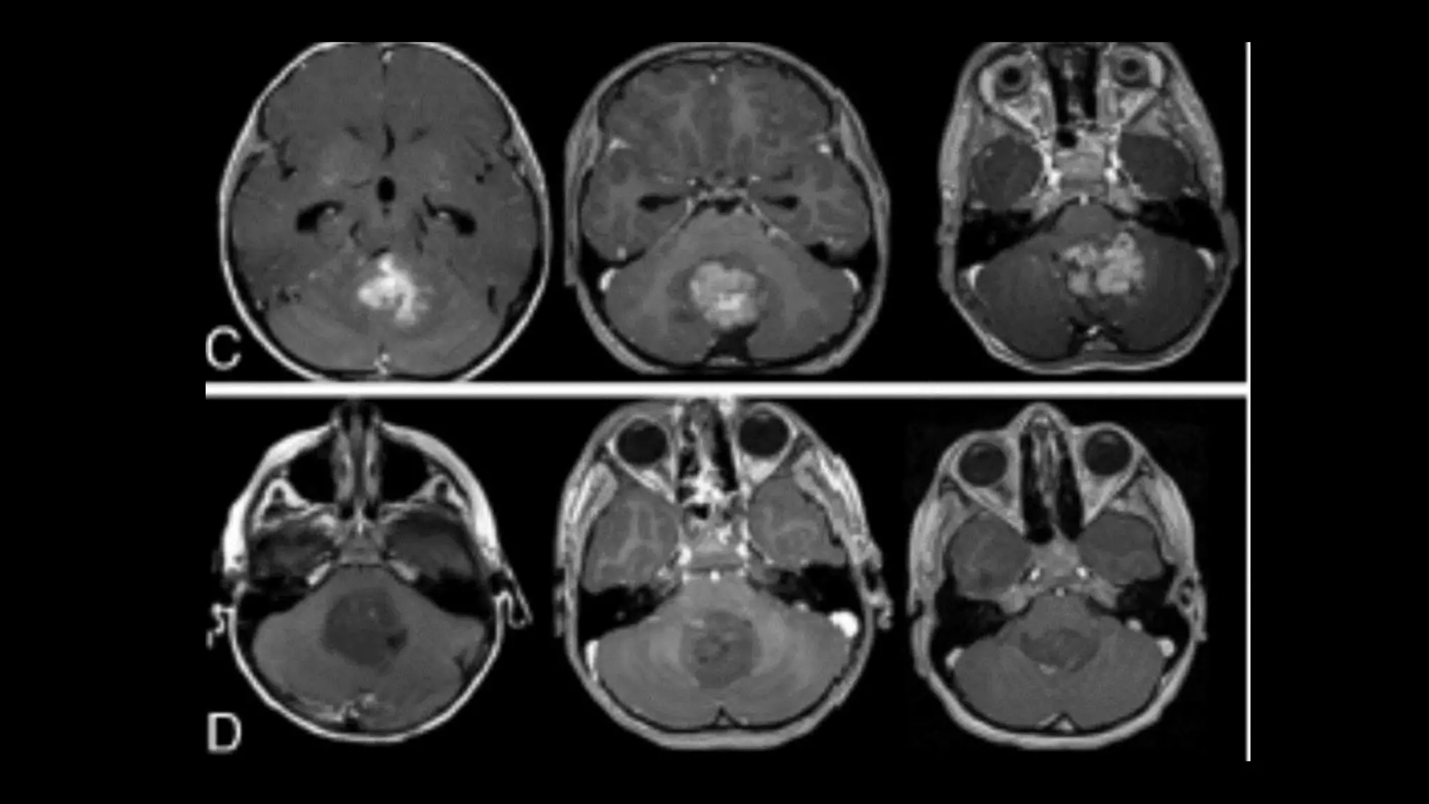Radiogenomics-pediatric brain tumor | PPTX