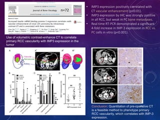 Radiogenomics of renal cell carcinoma | PDF