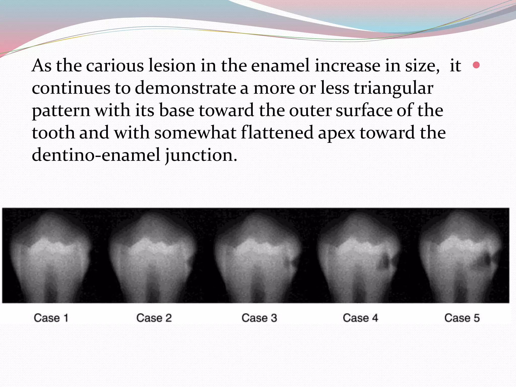 Dental common disease on x-ray | by Dr.mohammad nameer | PPTX