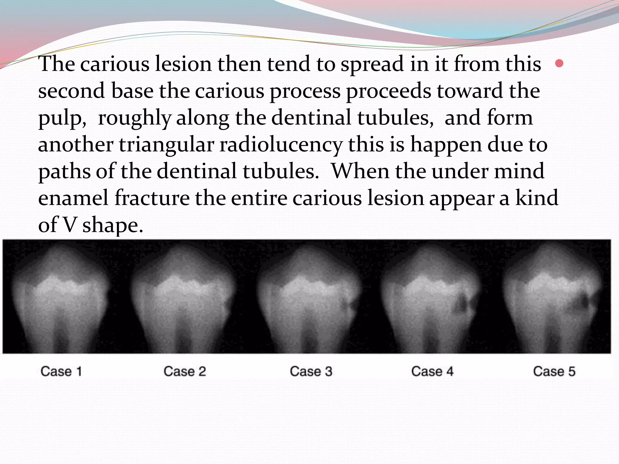 Dental common disease on x-ray | by Dr.mohammad nameer | PPTX