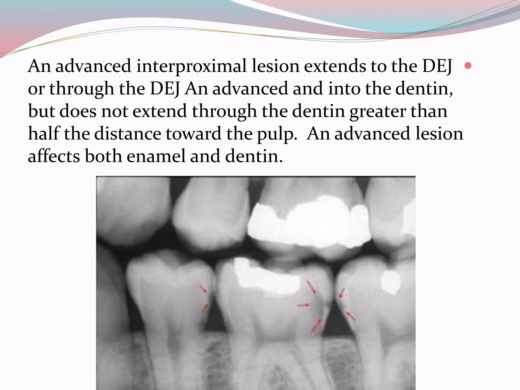 Dental common disease on x-ray | by Dr.mohammad nameer | PPTX