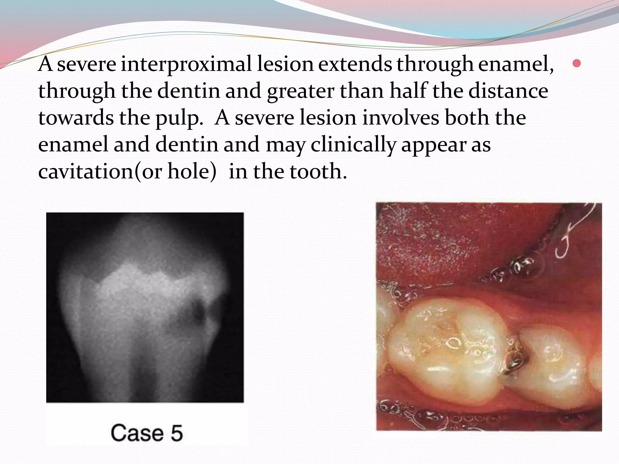 Dental common disease on x-ray | by Dr.mohammad nameer | PPTX