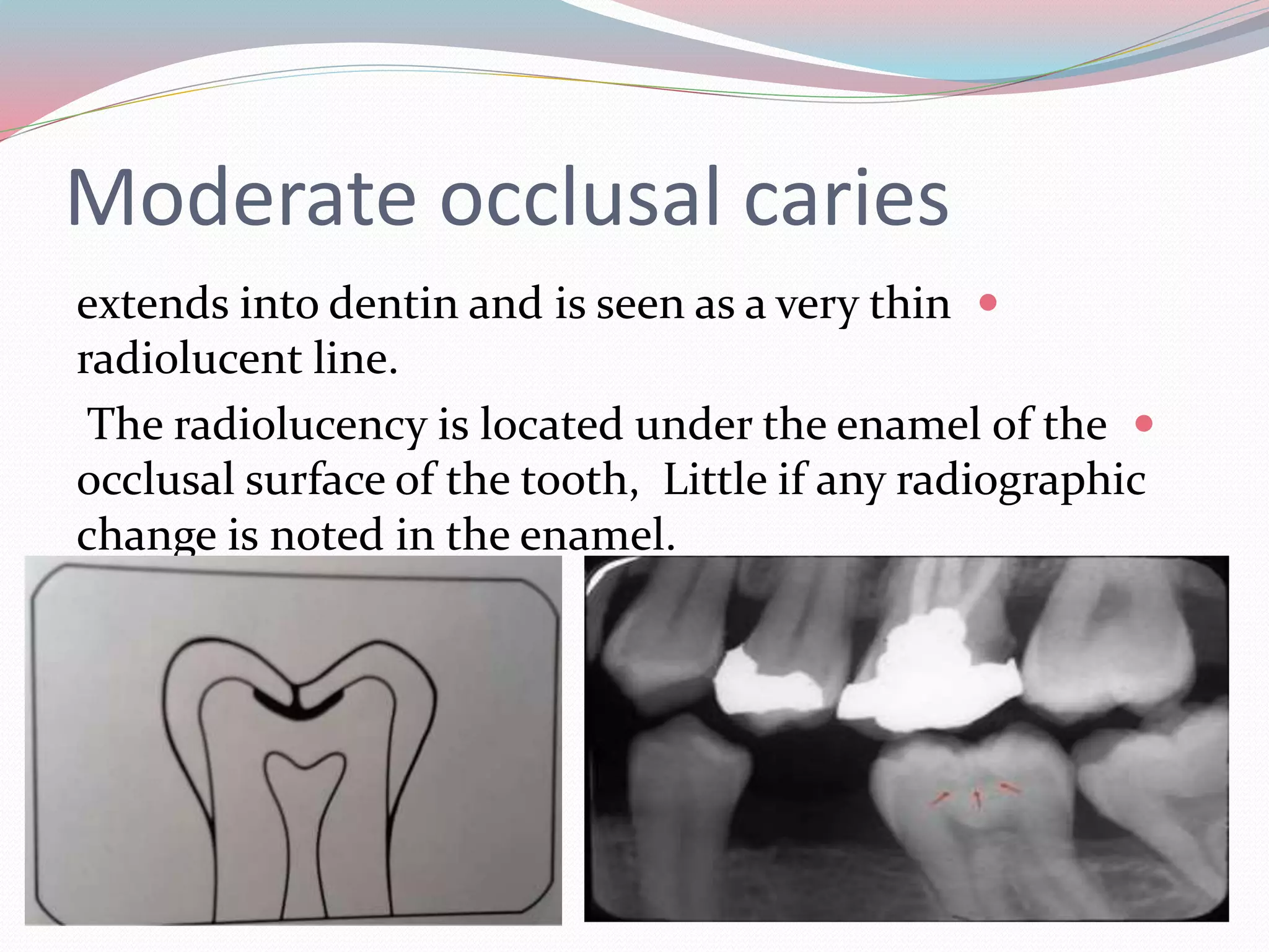Dental common disease on x-ray | by Dr.mohammad nameer | PPTX