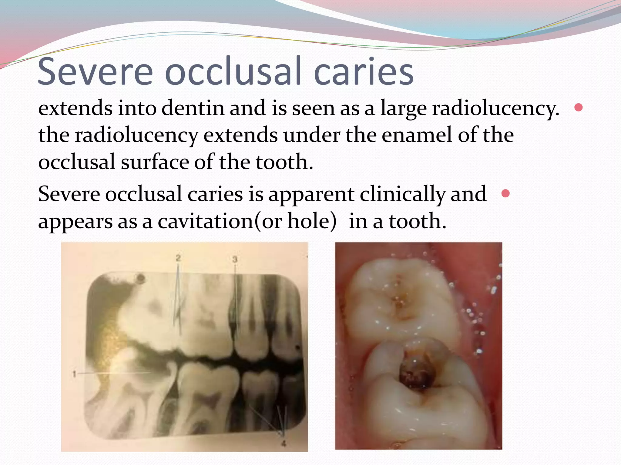 Dental common disease on x-ray | by Dr.mohammad nameer | PPTX