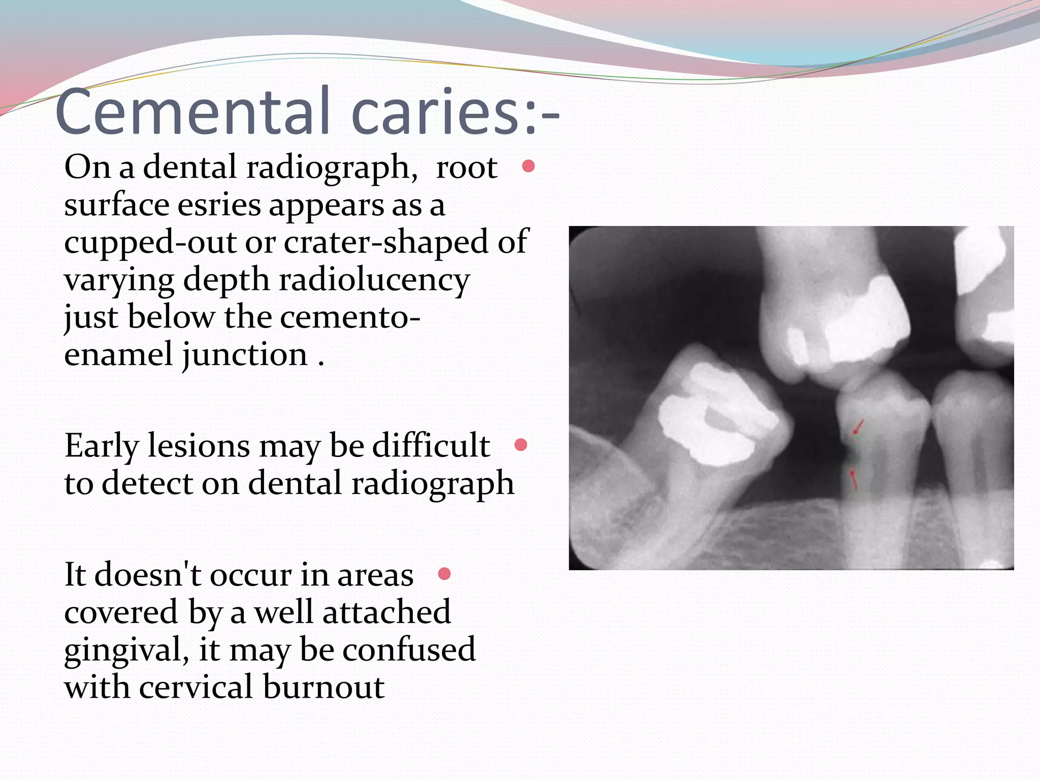 Dental common disease on x-ray | by Dr.mohammad nameer | PPTX