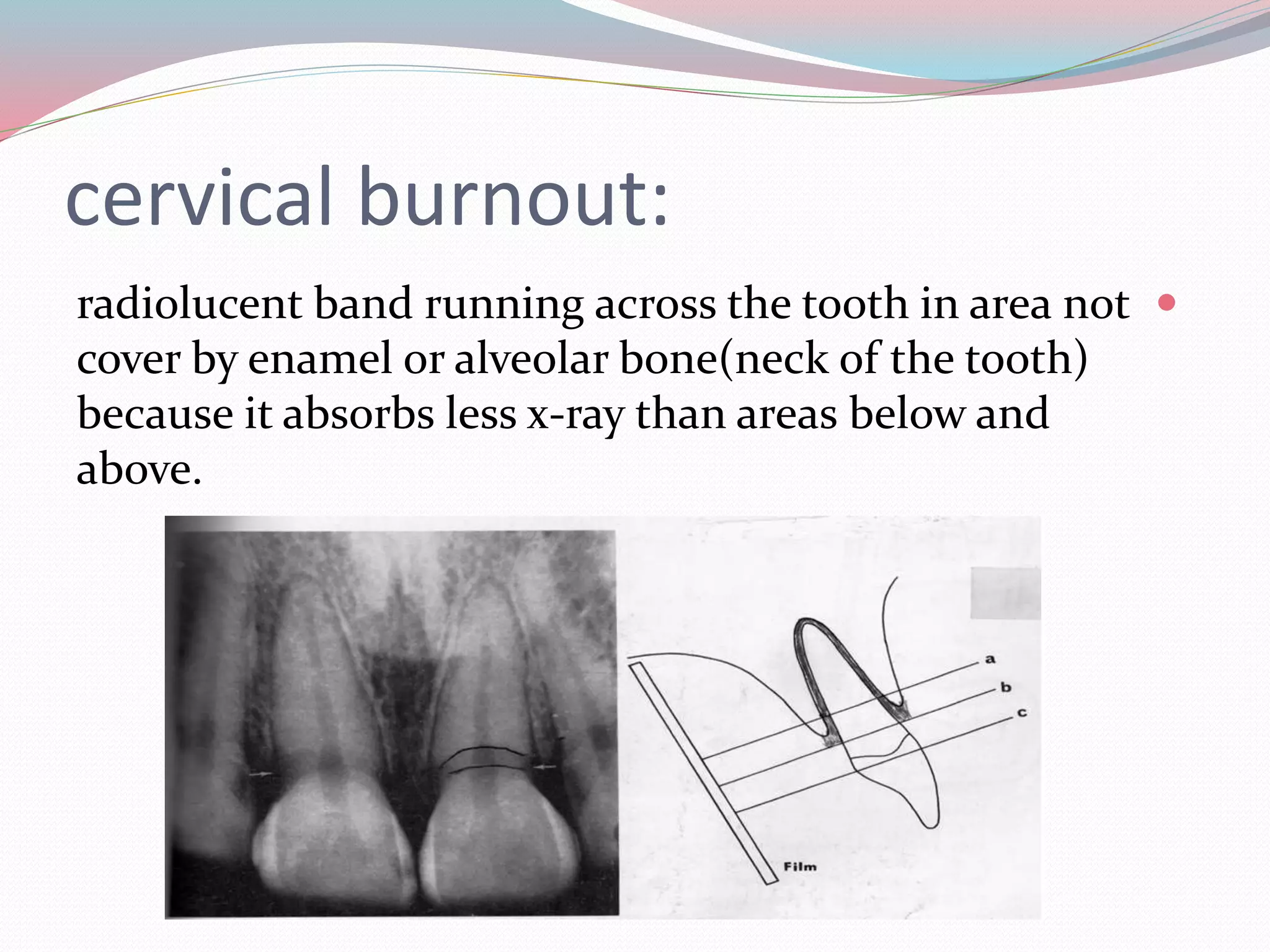 Dental common disease on x-ray | by Dr.mohammad nameer | PPTX