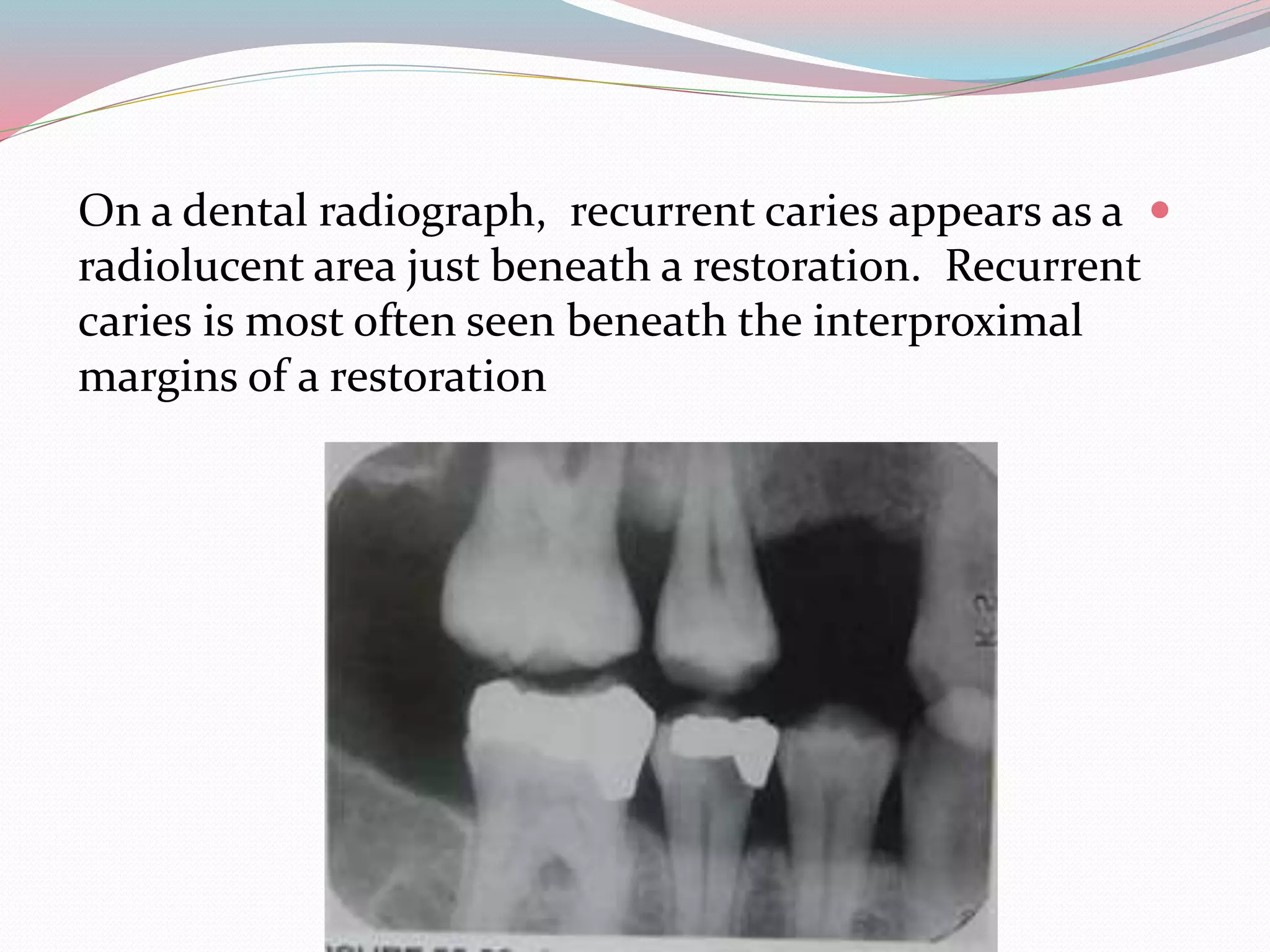 Dental common disease on x-ray | by Dr.mohammad nameer | PPTX