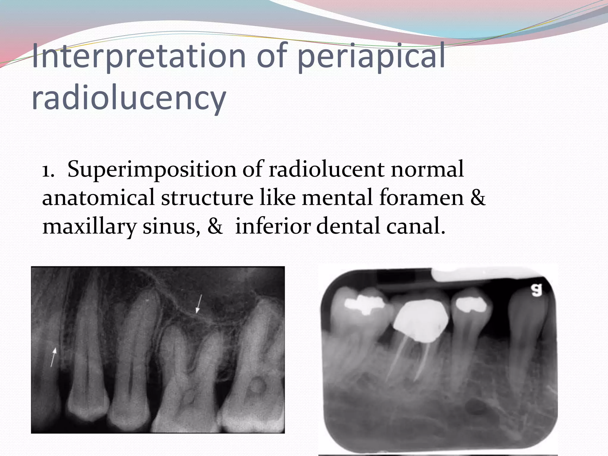Dental common disease on x-ray | by Dr.mohammad nameer | PPTX