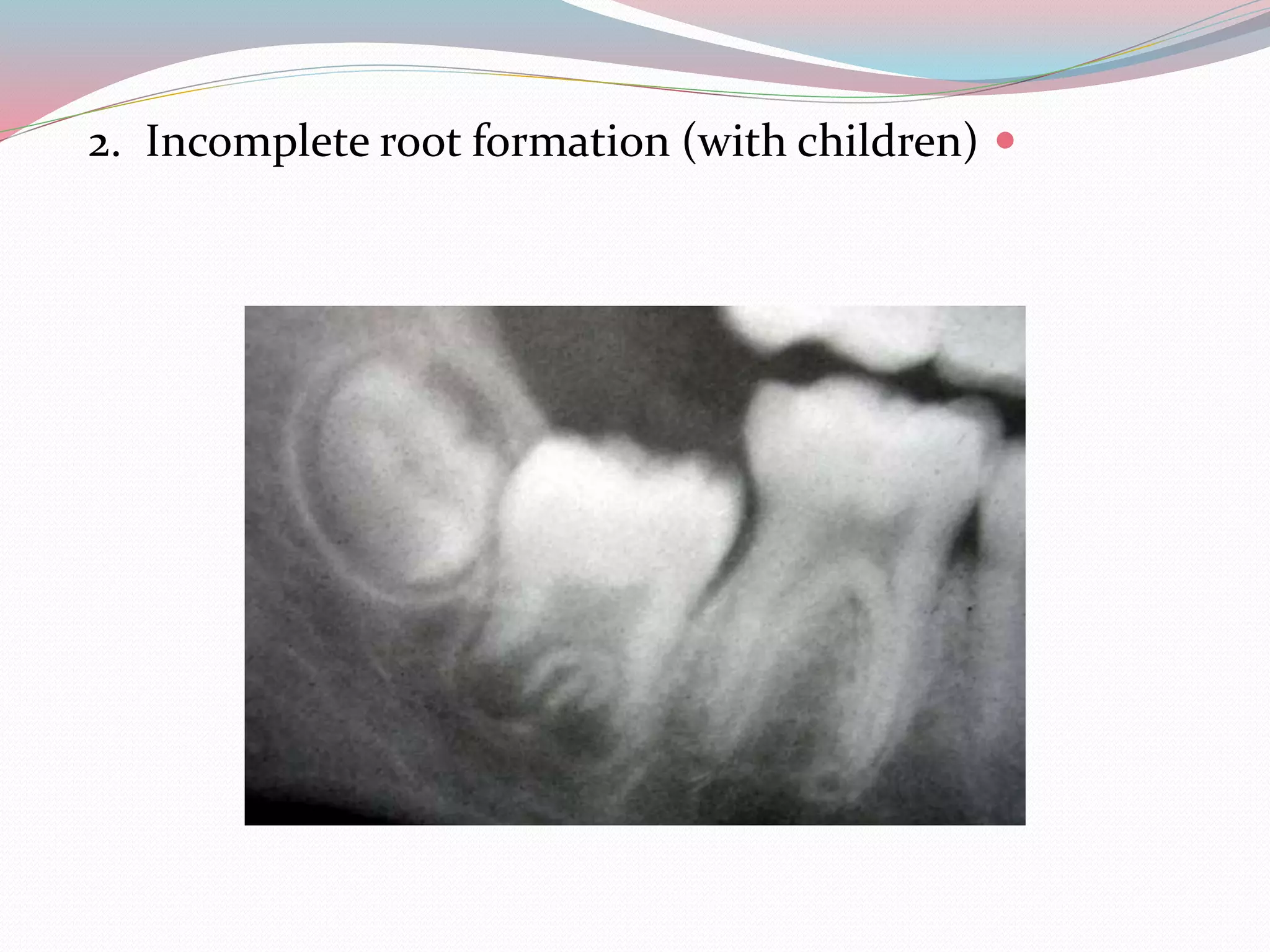Dental common disease on x-ray | by Dr.mohammad nameer | PPTX