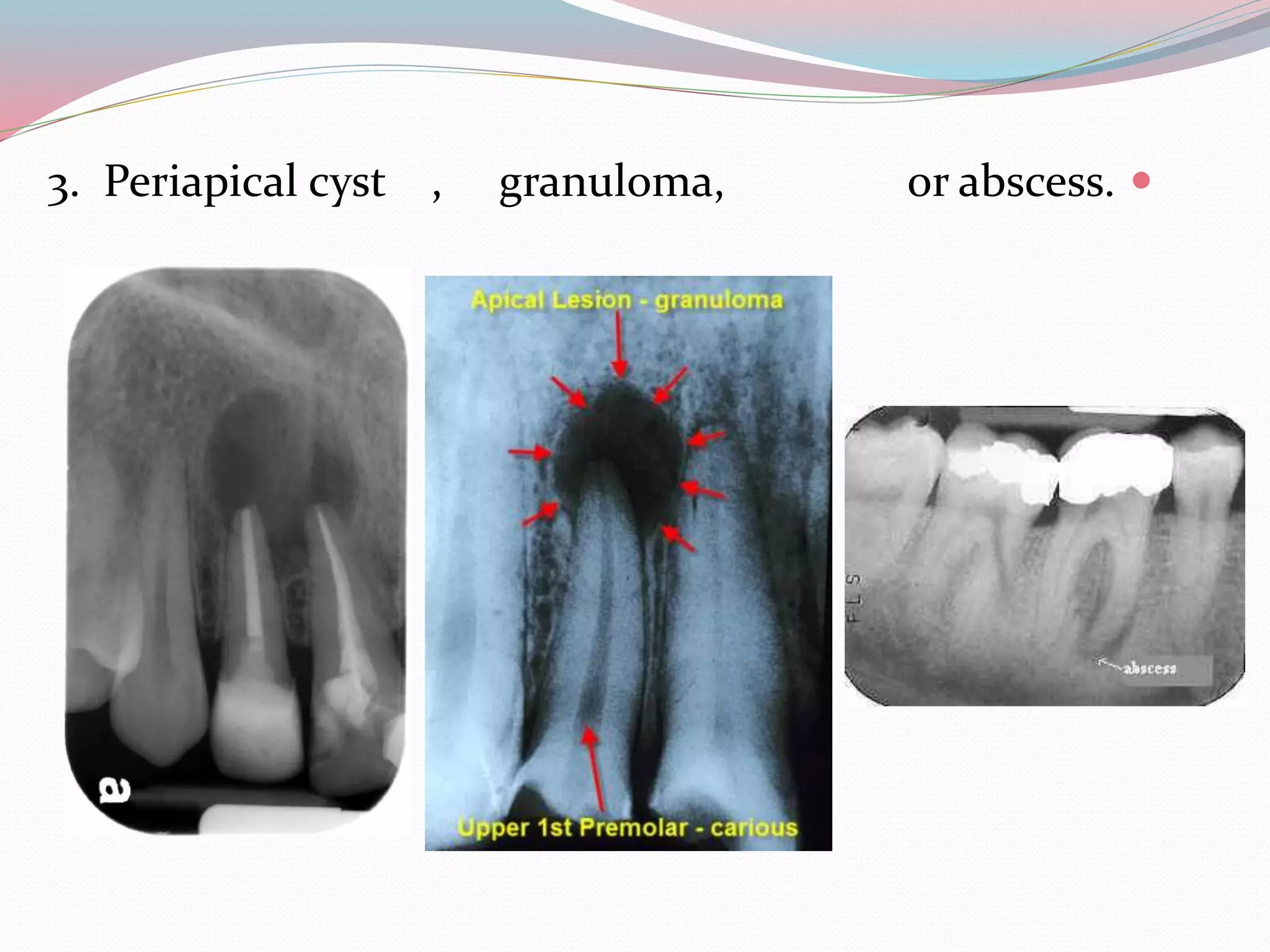 Dental common disease on x-ray | by Dr.mohammad nameer | PPTX