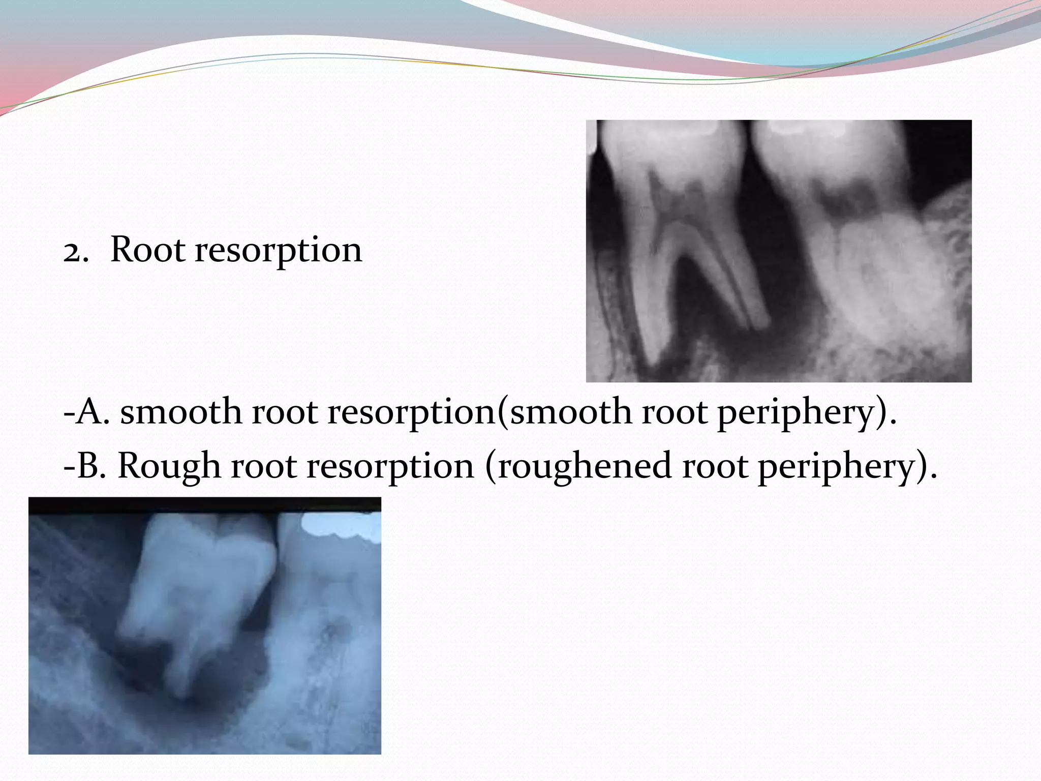 Dental common disease on x-ray | by Dr.mohammad nameer | PPTX