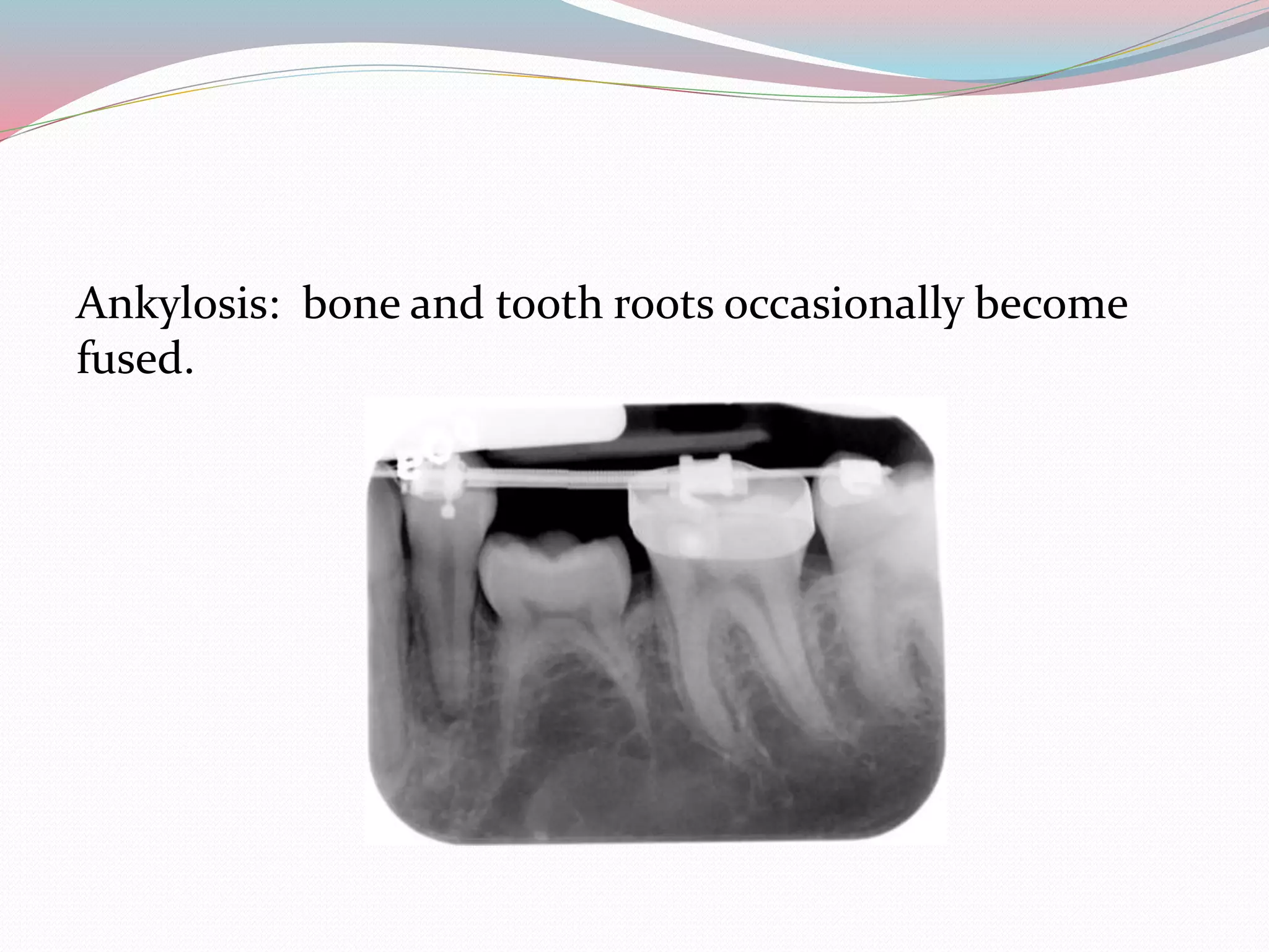 Dental common disease on x-ray | by Dr.mohammad nameer | PPTX