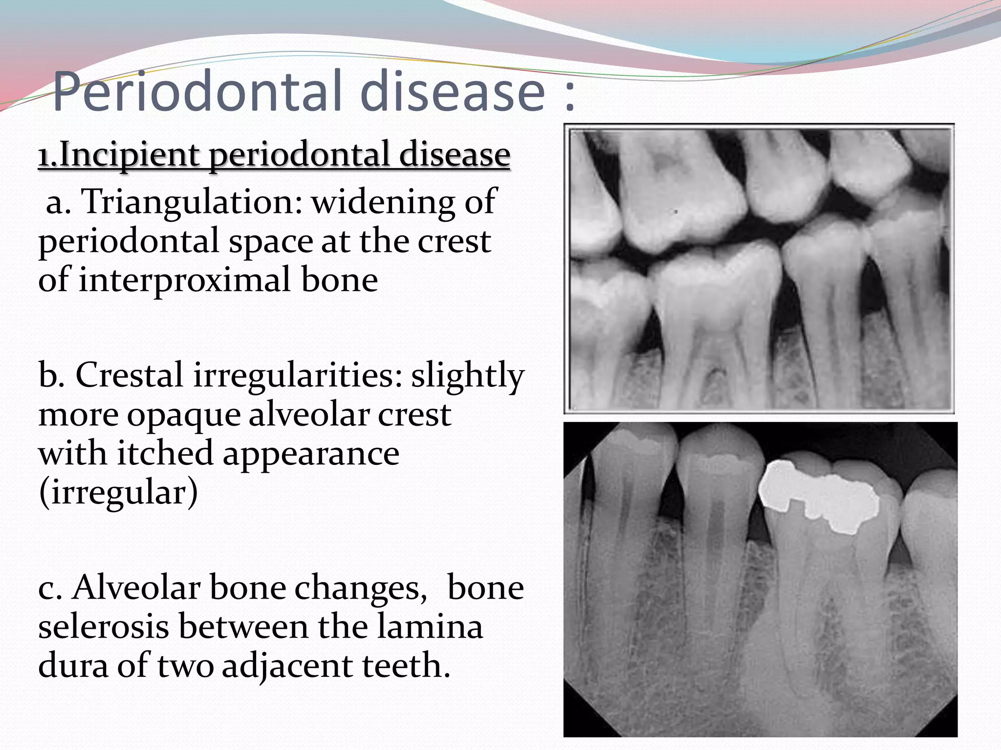 Dental common disease on x-ray | by Dr.mohammad nameer | PPTX