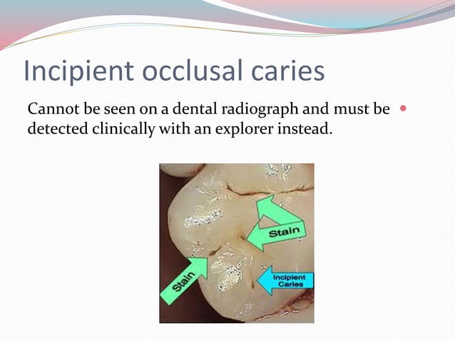 Dental common disease on x-ray | by Dr.mohammad nameer | PPTX