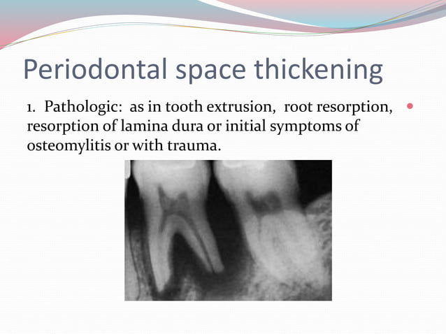 Dental common disease on x-ray | by Dr.mohammad nameer | PPTX