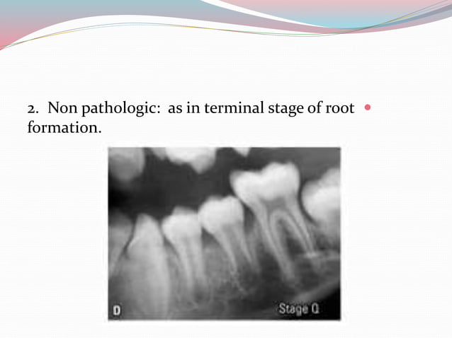 Dental common disease on x-ray | by Dr.mohammad nameer | PPTX