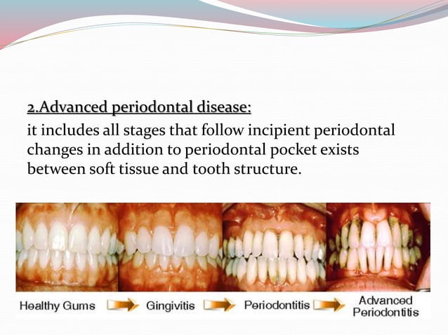 Dental common disease on x-ray | by Dr.mohammad nameer | PPTX