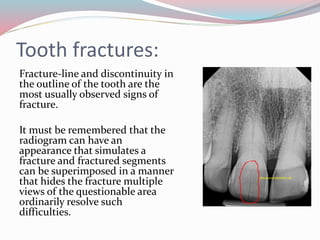 Dental common disease on x-ray | by Dr.mohammad nameer | PPTX