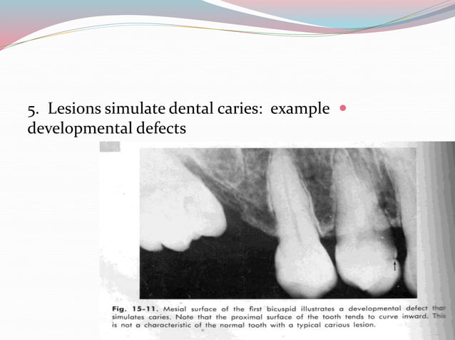 Dental common disease on x-ray | by Dr.mohammad nameer | PPTX