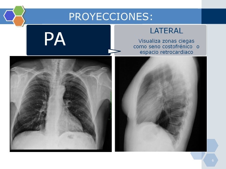 Radiografía de tórax