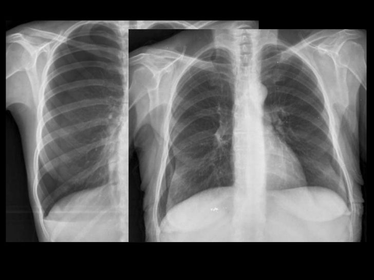 Radiografía de tórax