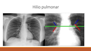 Radiografía de tórax cardiologia | PPTX