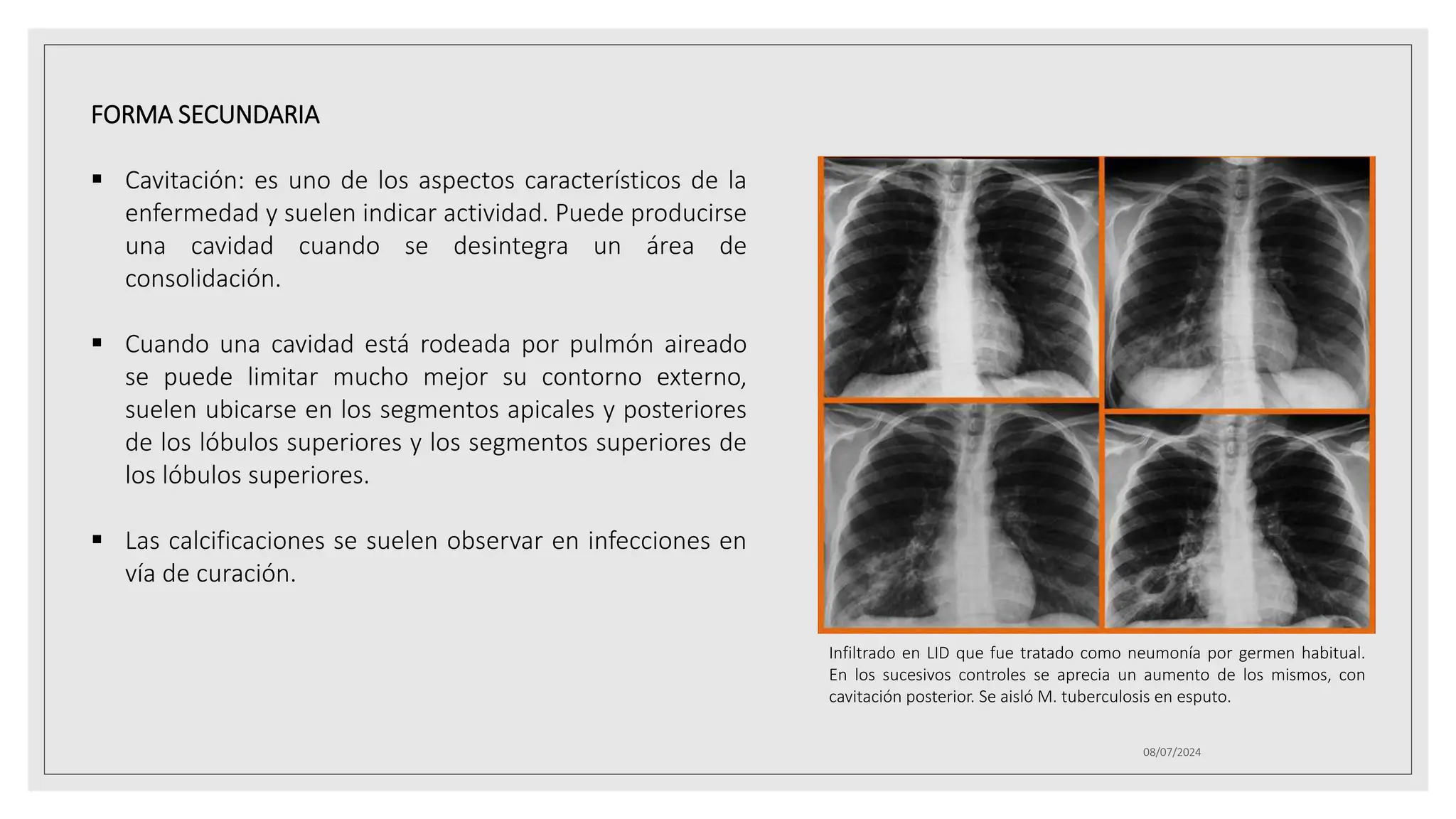 Radiografía de Tórax patológico y normal.pptx