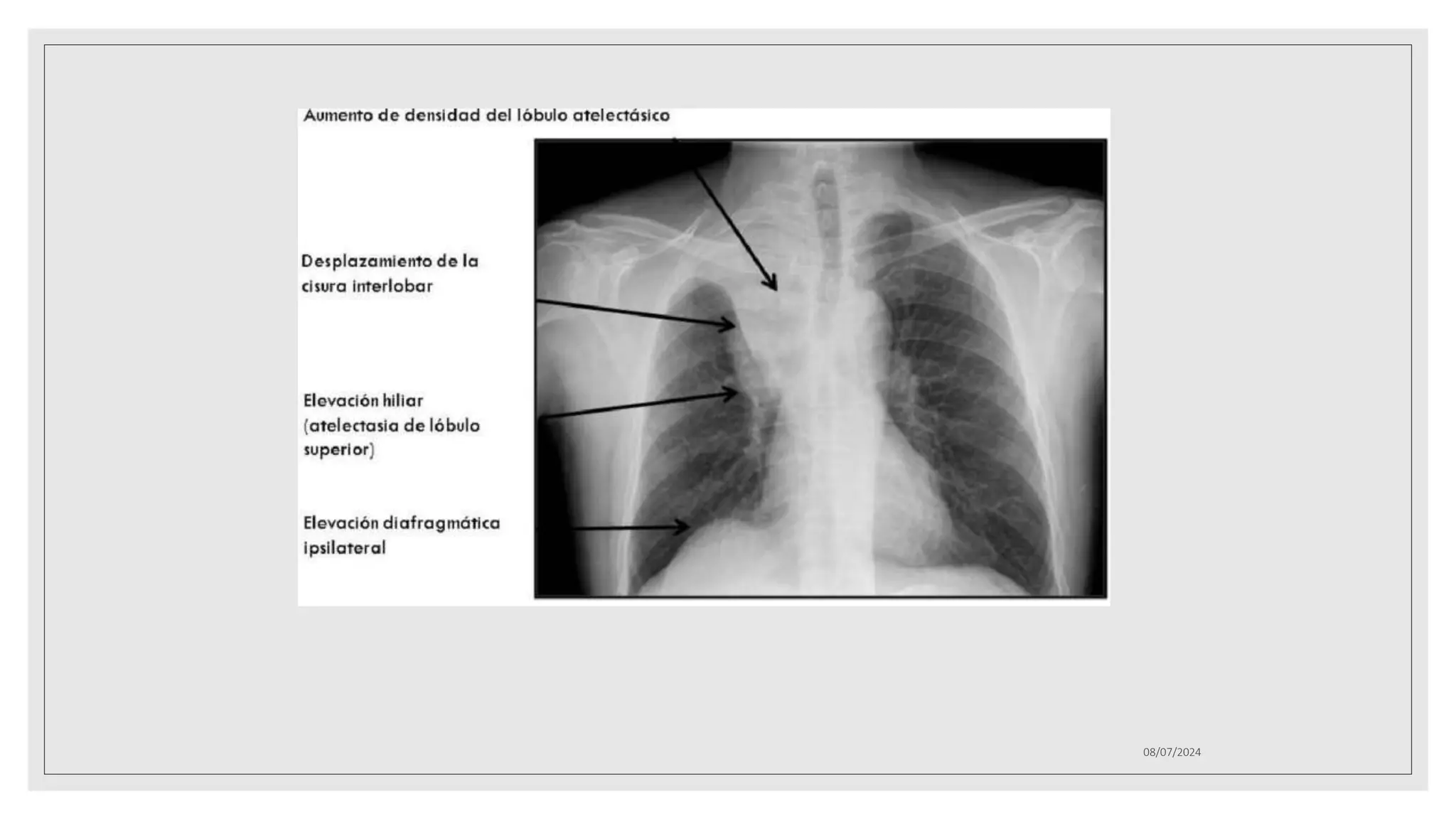 Radiografía de Tórax patológico y normal.pptx