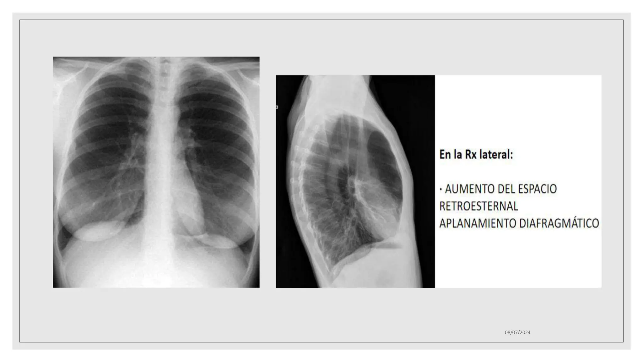Radiografía de Tórax patológico y normal.pptx