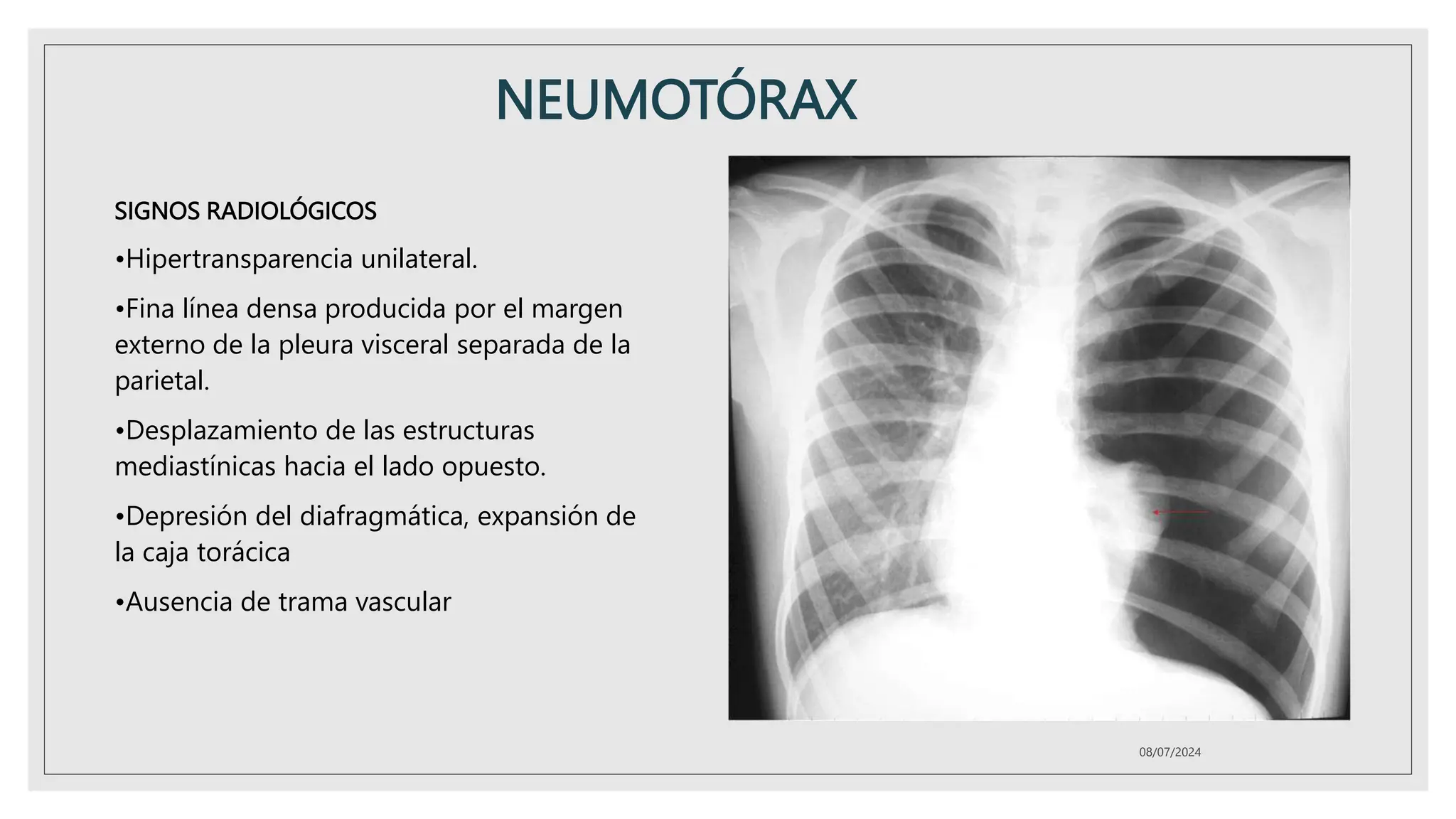 Radiografía de Tórax patológico y normal.pptx