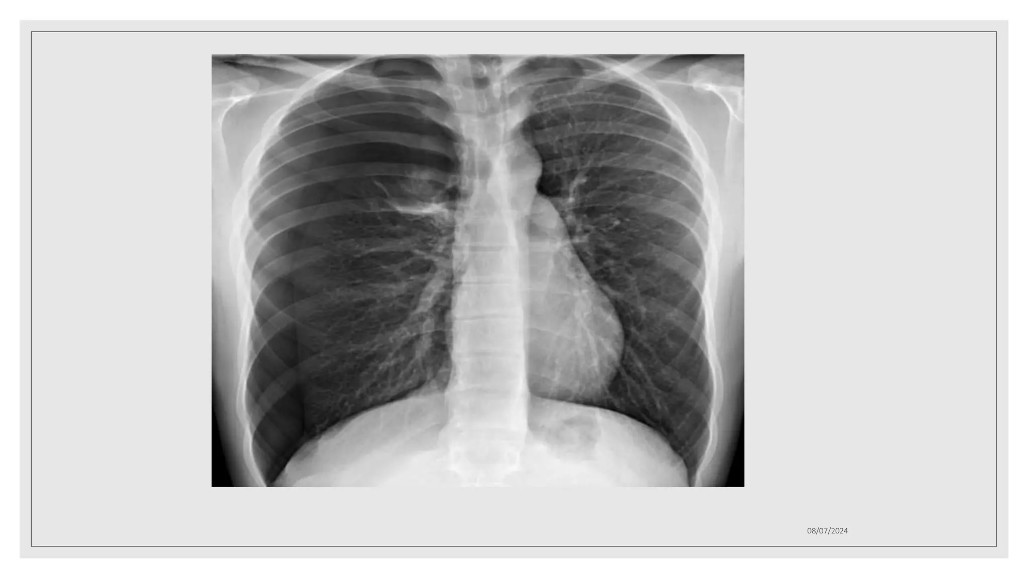 Radiografía de Tórax patológico y normal.pptx